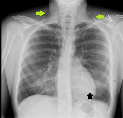 A finding of subcutaneous emphysema: Diagnosing and managing Hamman’s ...