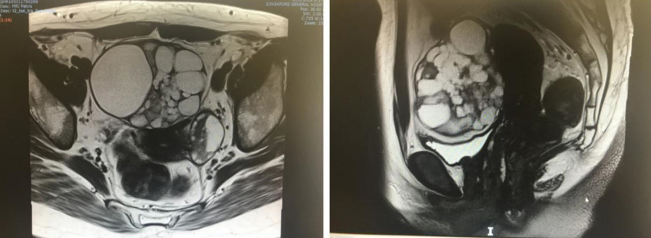 Hyperfunctioning benign struma ovarii in a young patient with Graves ...