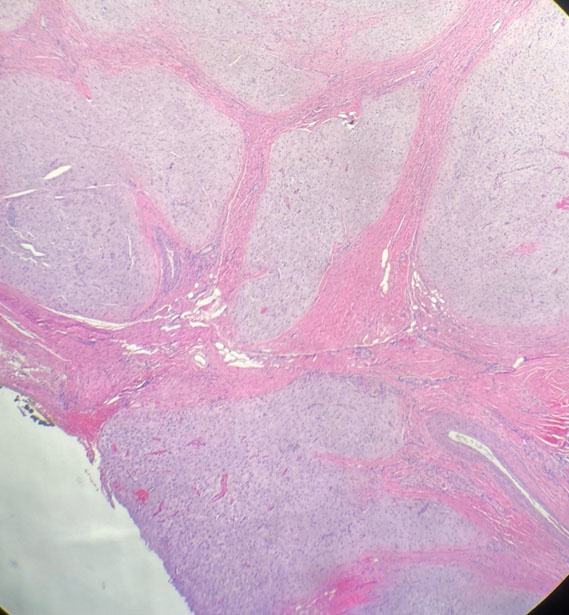 Cutaneous endometriosis: Symptomatic manifestation during pregnancy—A ...