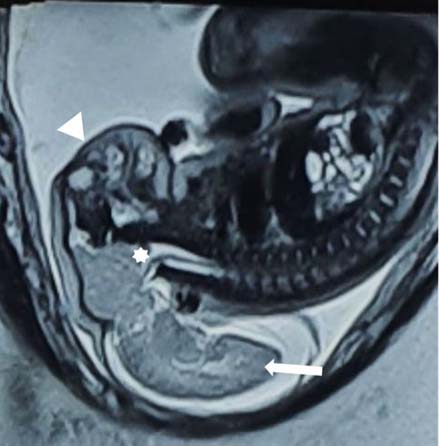 Fetal acrania: A case report and review of literature - Journal of Case ...