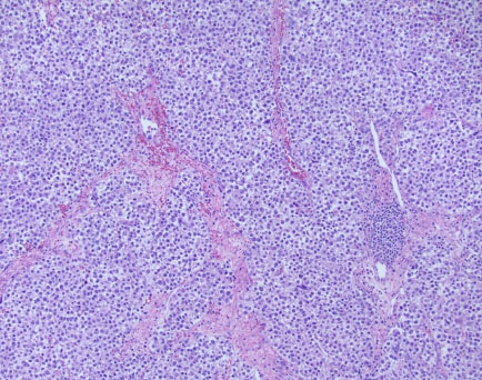 Ovarian dysgerminoma in a 14-year-old presenting with an adnexal mass ...