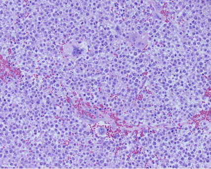 Ovarian dysgerminoma in a 14-year-old presenting with an adnexal mass ...