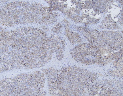 Ovarian dysgerminoma in a 14-year-old presenting with an adnexal mass ...