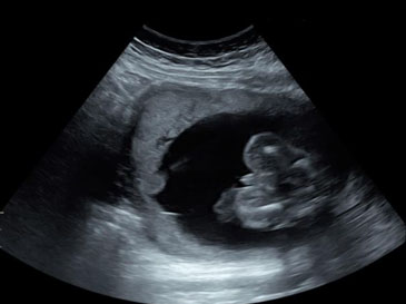 Mesh infection after umbilical hernia repair in a pregnant female ...