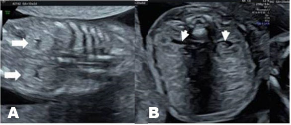 Upj Obstruction Ultrasound Prenatal Diagnosis, Management, And