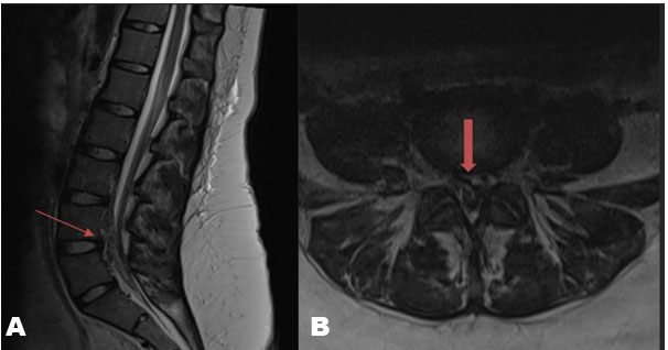 Spinal stenosis secondary to engorged Batson’s plexus in pregnancy ...