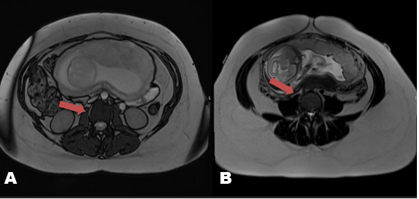 Spinal stenosis secondary to engorged Batson’s plexus in pregnancy ...